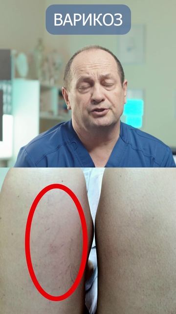 Настоящая причина вашего варикоза, о которой вы и не догадывались! #варикоз #варикознаяболезнь