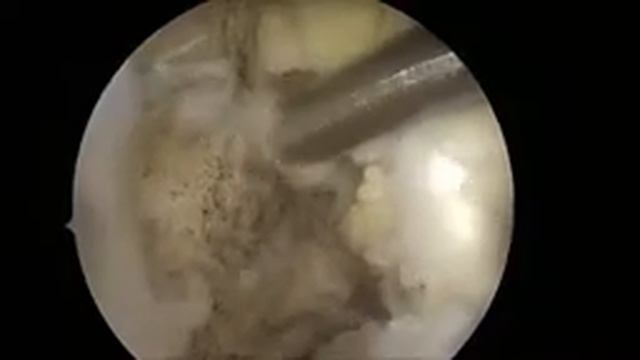 Работа аблятора