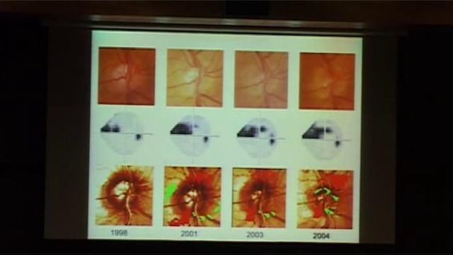 Глаукома_ 5 спорных вопросов