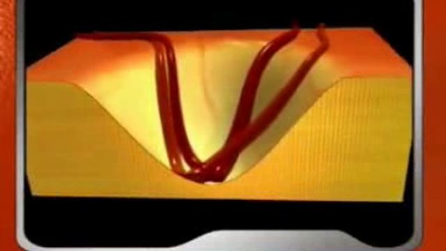 El Glaucoma - La ceguera silenciosa