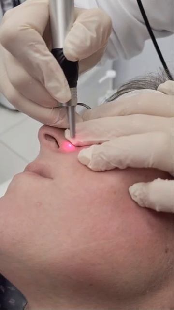 Удаление сосудов на крыльях носа