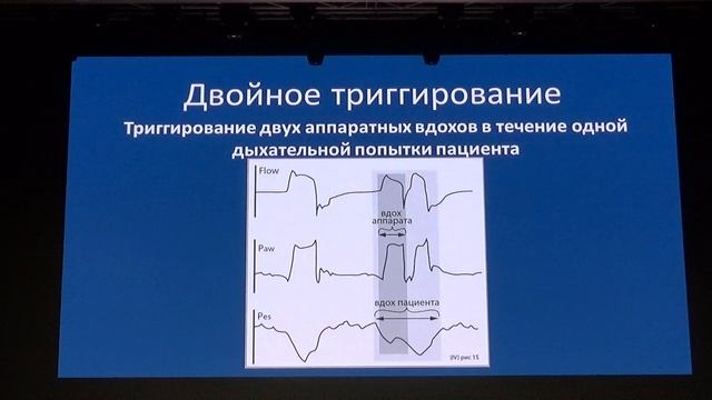 Ассинхрония пациента и аппарата ИВЛ Полупан А.А.