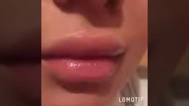 Увеличение губ гиалуроновой кислотой в Новосибирске