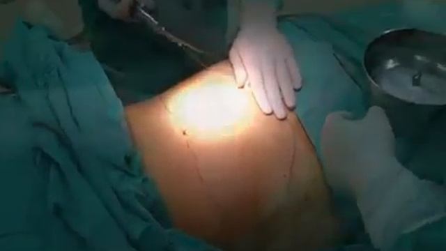 QuadroStar и асистированный липолиз