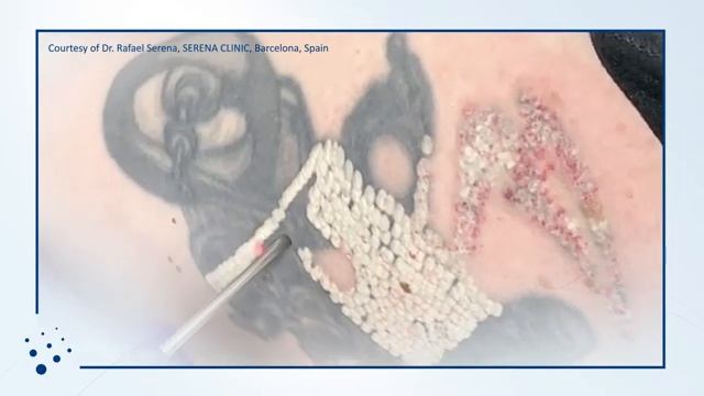 Новейший пикосекундный лазер Asclepion PicoStar!