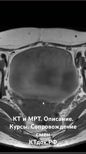 Эндометриоидная киста