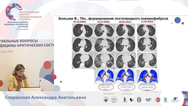 КТ МРТ постковидные изменения легких Сперанская АА СПб 2023