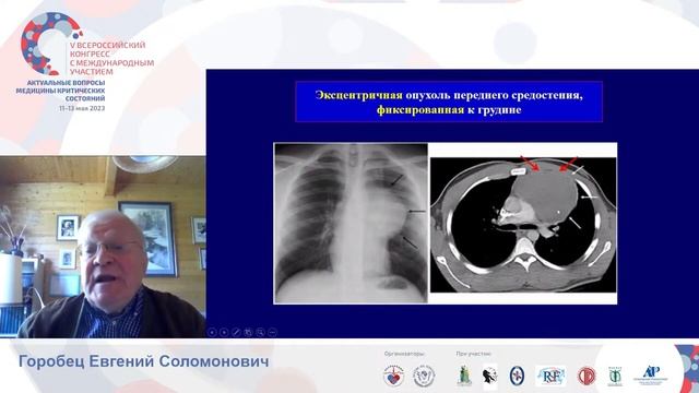 Медиастенальный компрессионный синдром Горобец ЕС  СПб 2023