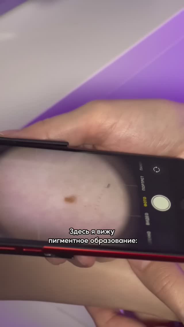 Как узнать опасна ли родинка❓