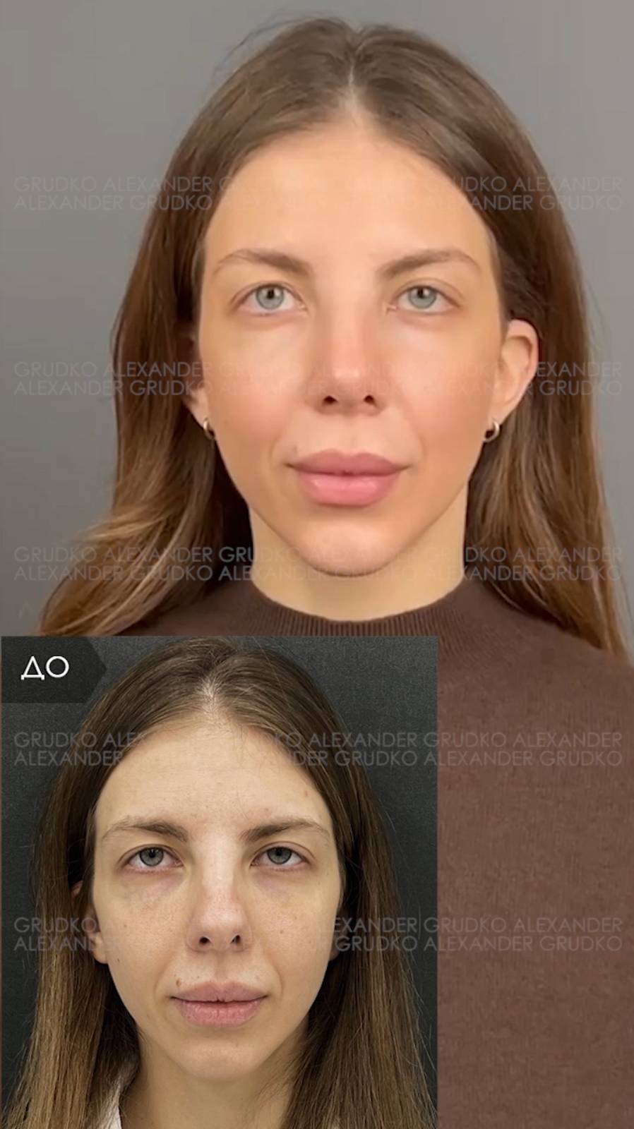 Отзыв после ринопластики