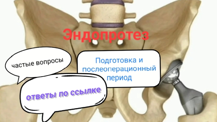 Эндопротезирование тазобедренного сустава. Ответы на вопросы по ссылке в описании.