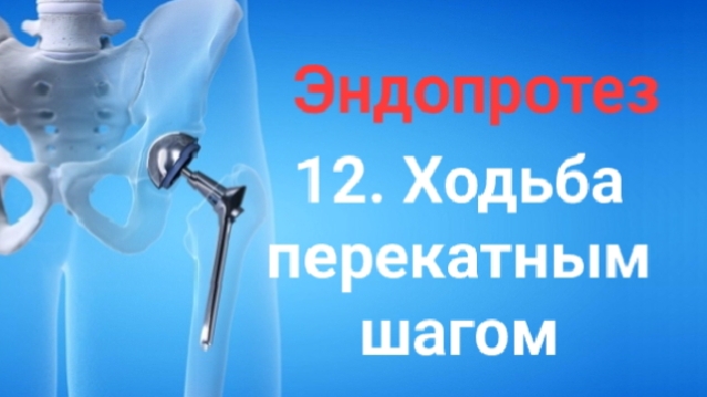 0.12 эндопротез тбс, перекатный шаг