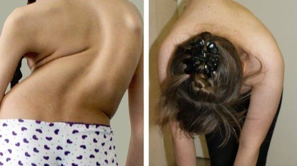 Сколиоз-Документальный фильм