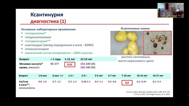 Ксантинурия - редкая причина уролитиаза у детей