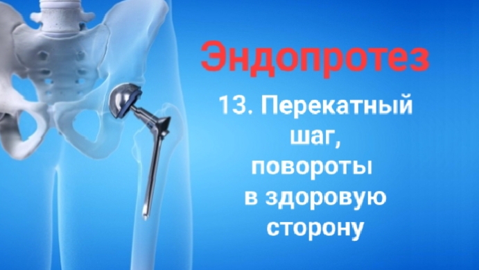 0.13 эндопротез, поворот в здор.сторону