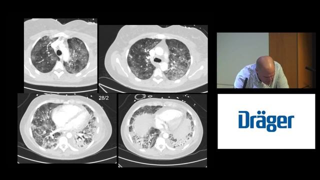 Is this ARDS  Boris Lams  AVS 2015