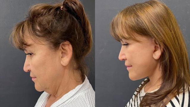 Комплексное омоложение для моей прекрасной пациентки