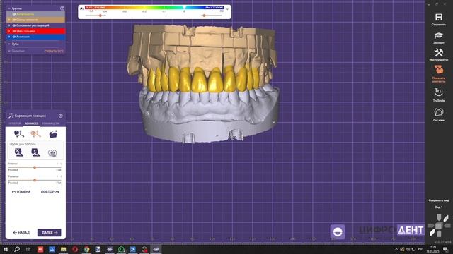 Полная анатомия на культях с редуцированием фронтальной группы зубов