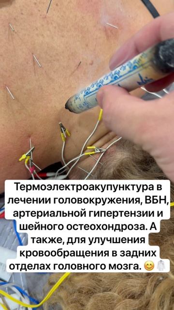Термоэлектроакупунктура в лечении головокружения, ВБН, артериальной гипертензии и шейного остеохондр