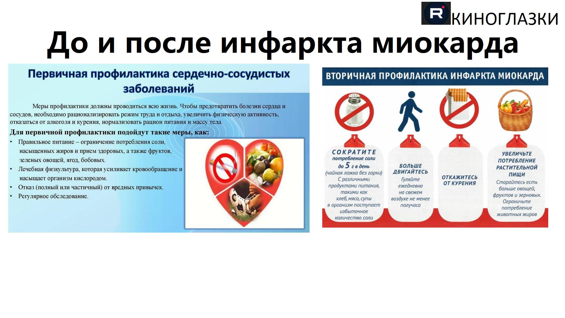 Инфаркт миокарда до и после