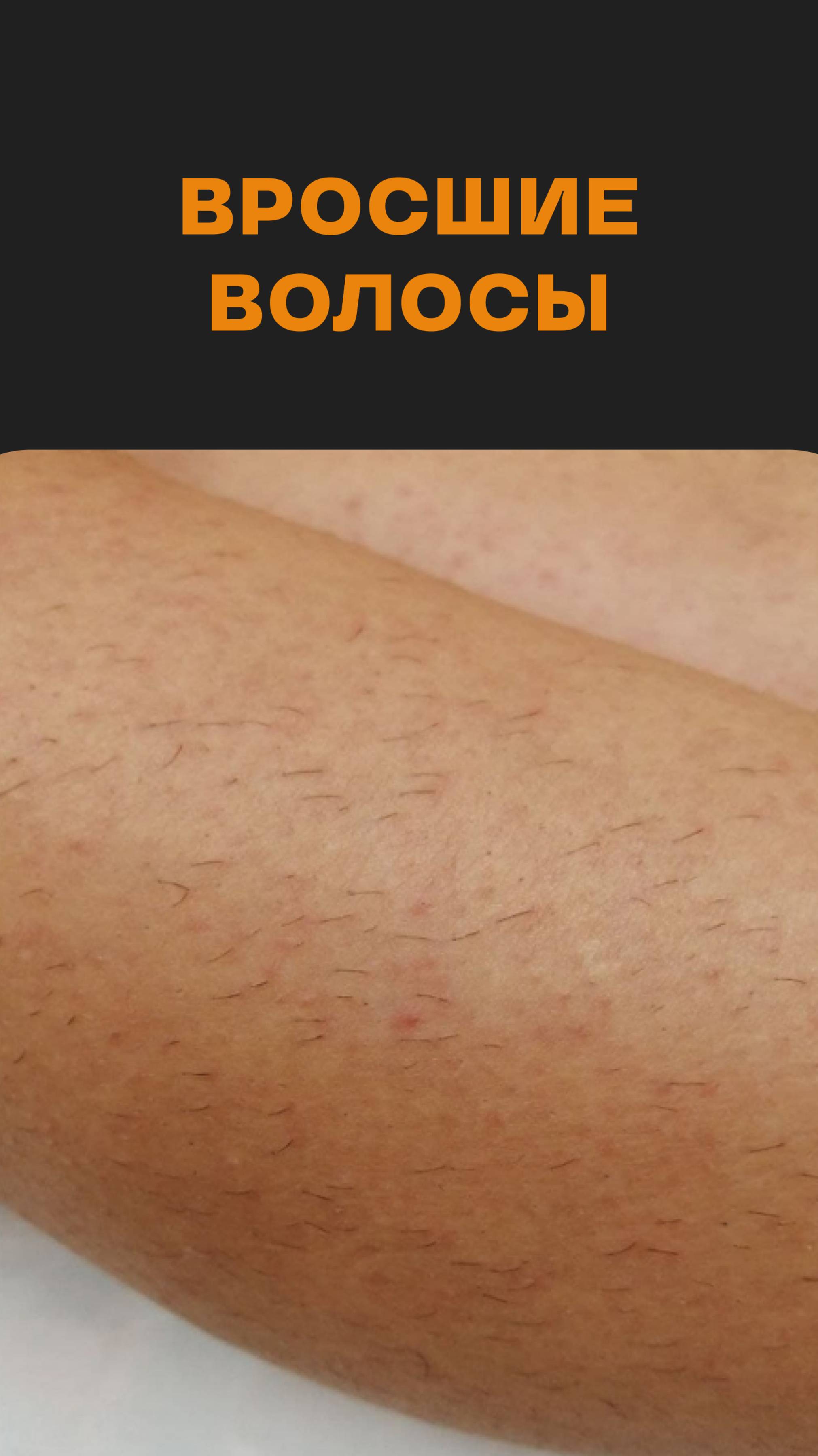 виды вросших волос депиляция