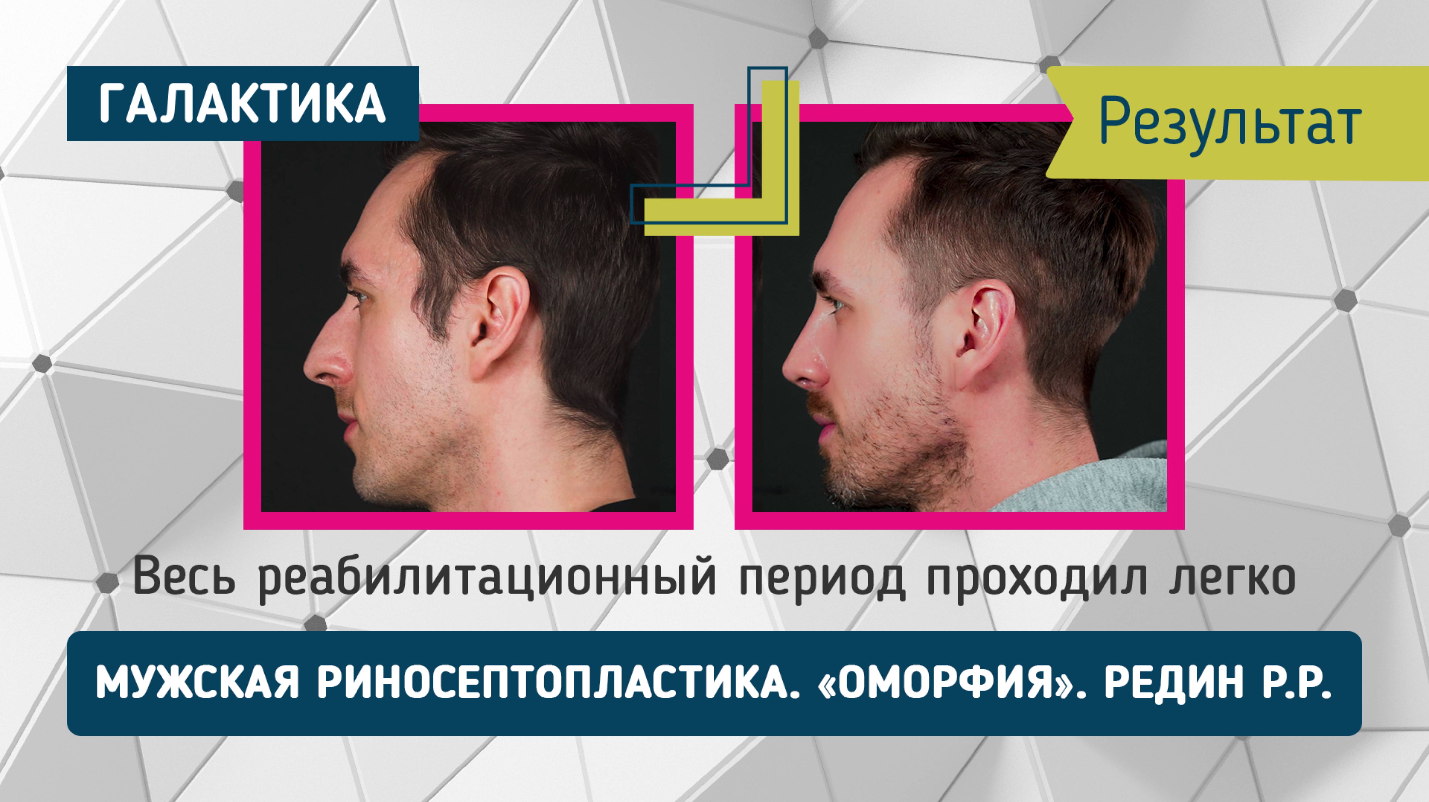 Проект "Оморфия": Мужская риносептопластика - результат | Редин Роман Романович