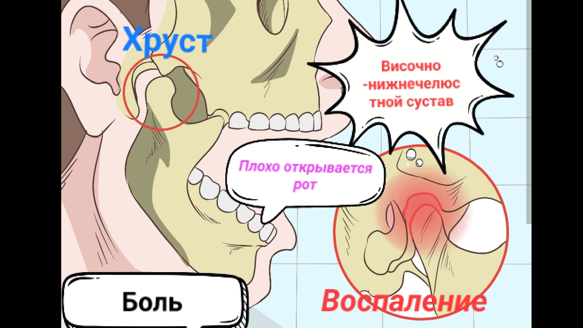 Височно-нижнечелюстной сустав, дисфункция. Хруст, боль, тугоподвижность нижней  челюсти.