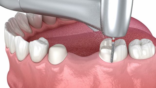 Обработка зубов перед протезированием (мостик)
