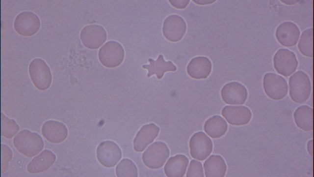 микроскопия нативной крови, пойкилоцитоз, гемосканирование -Акантоцит- эритроцит с 8 ножками