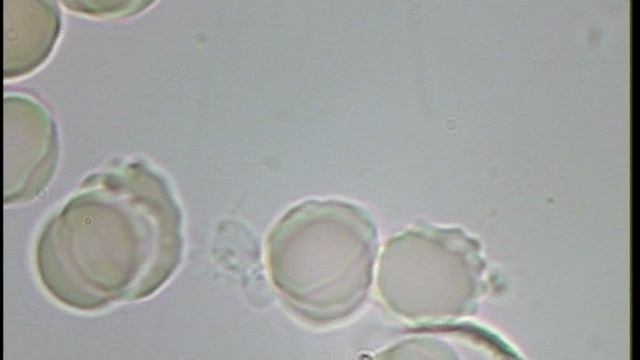 МНК микроскопия нативной крови, пойкилоцитоз, гемосканирование, эритроцит +грибы, движение мицелия