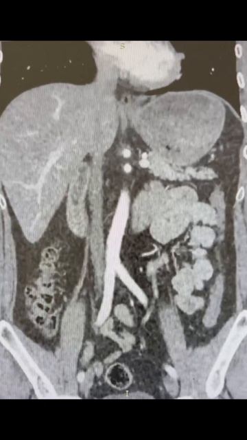 Кистозная опухоль почки