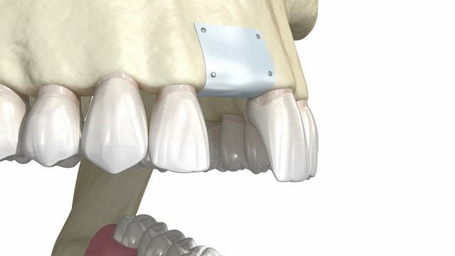 Наращивание кости