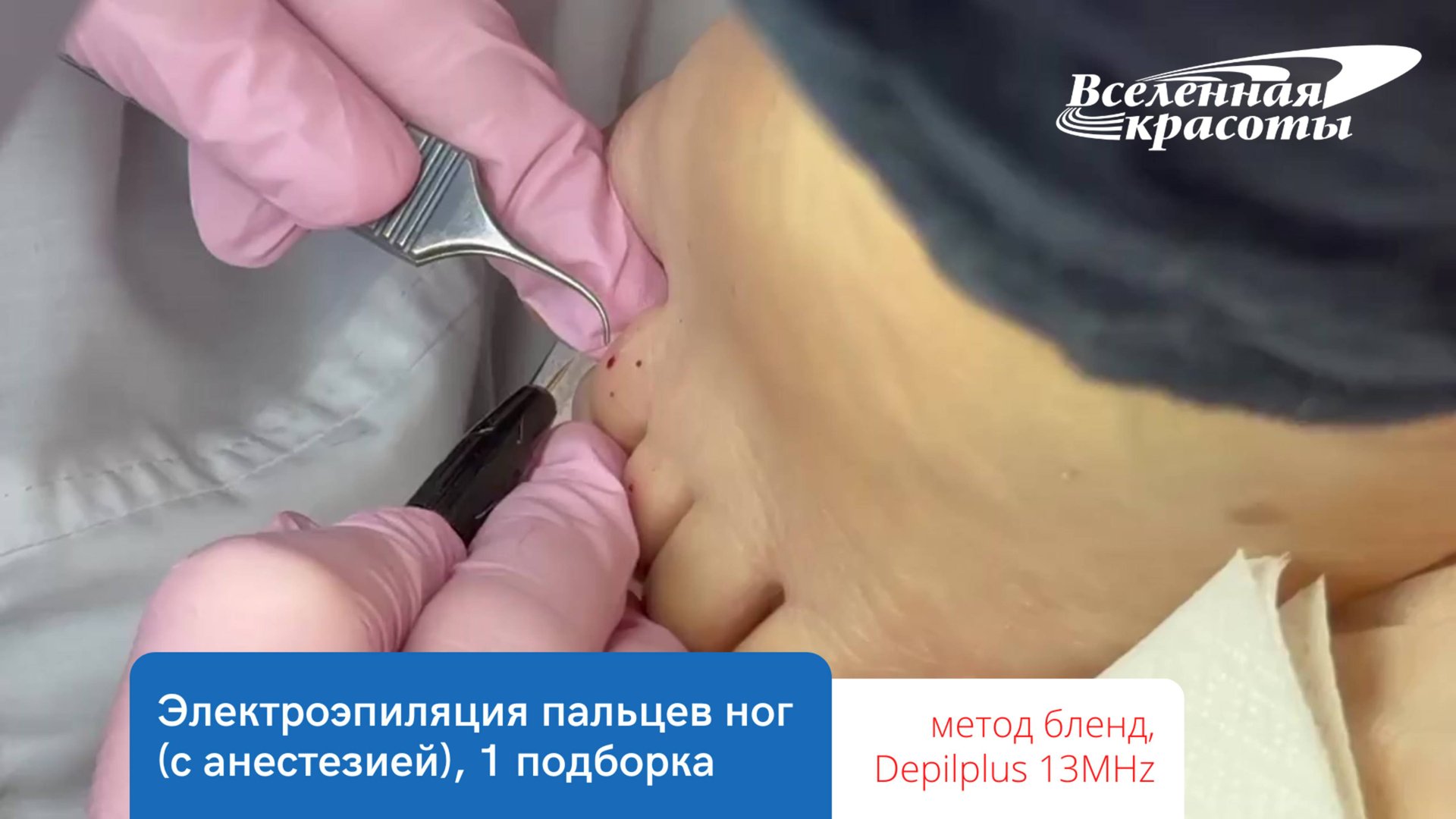 Электроэпиляция пальцев ног методом blend