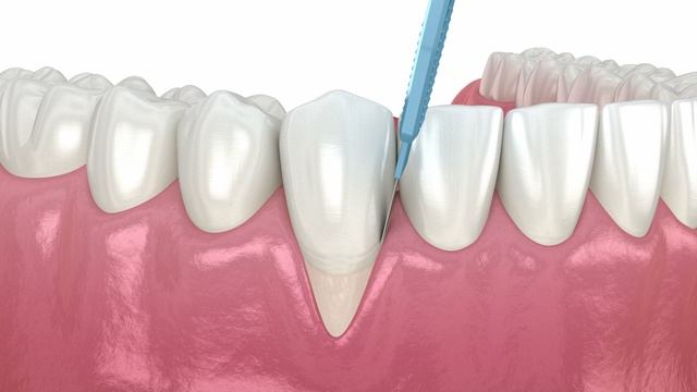 Наращивание десны