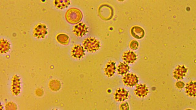 20170503-193658-ENG МНК микроскопия нативной крови, пойкилоцитоз, гемосканирование