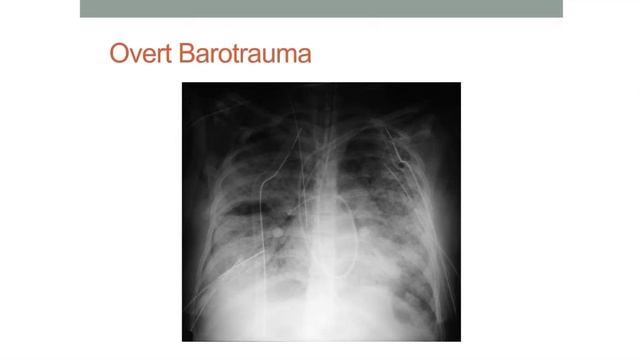 Major advanses in MV 40 year perspective David Willms 2023