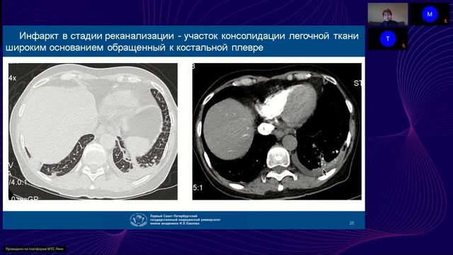 Синдром легочного инфильтрата - что это такое? Взгляд рентгенолога.