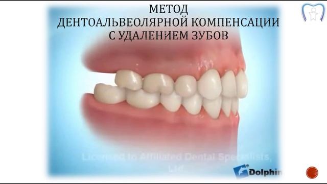 Дистальная окклюзия с протрузией