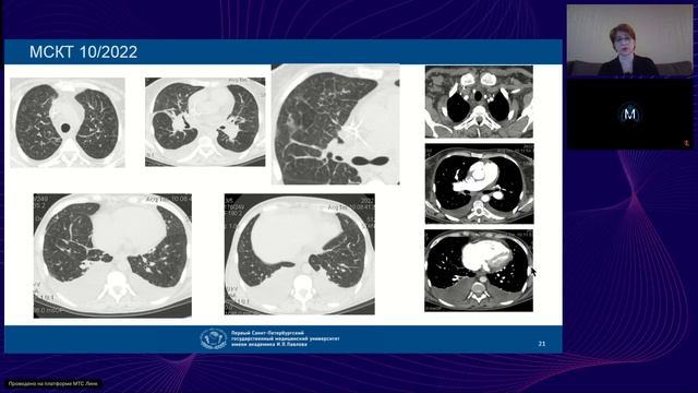 Ретикулярные изменения и изменения в бронхах