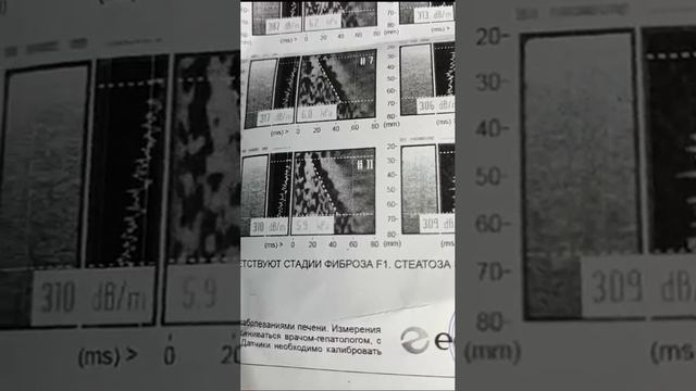 Хемохим. Исцеление. Фиброз печени F2. Отзыв из Дагестана
