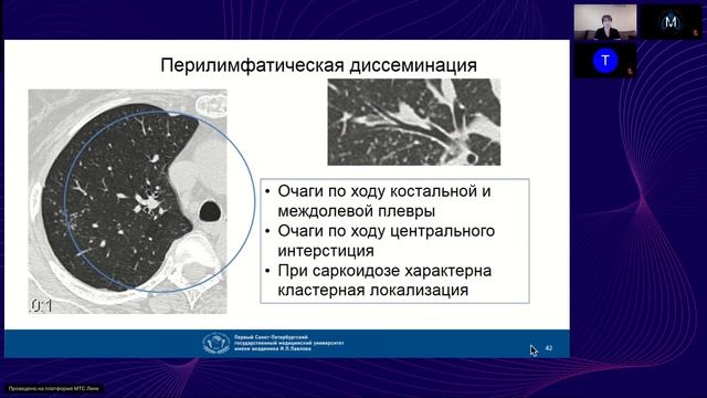 Очаги в легких - возможности и ограничения при КТ