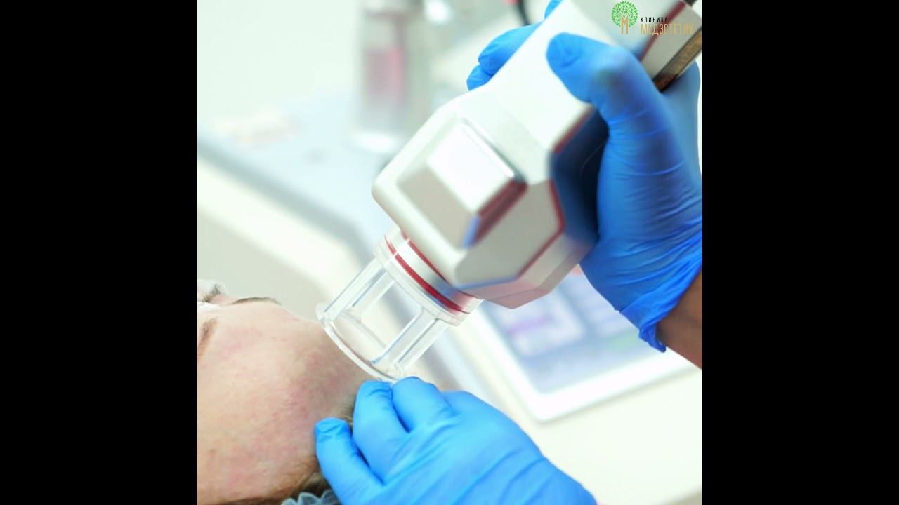 Лазерная шлифовка Cosmopulse II