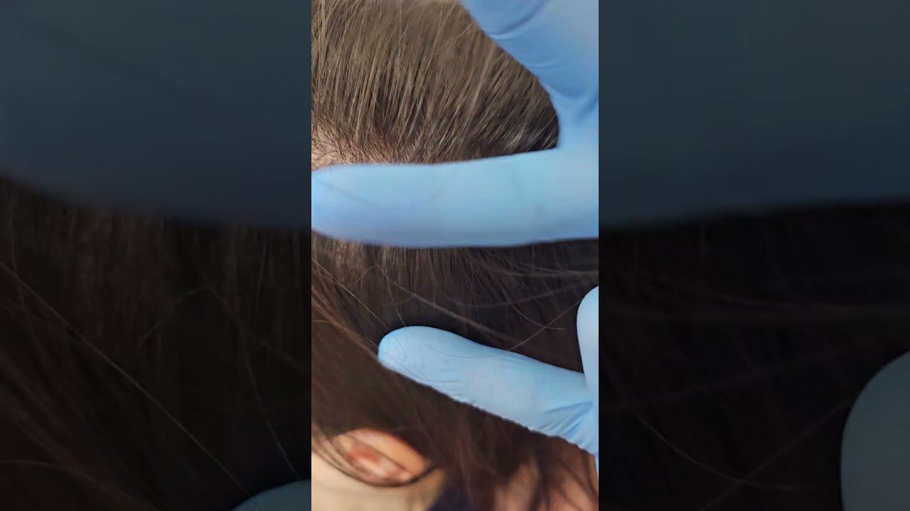 Карбокситерапия волосистой части головы