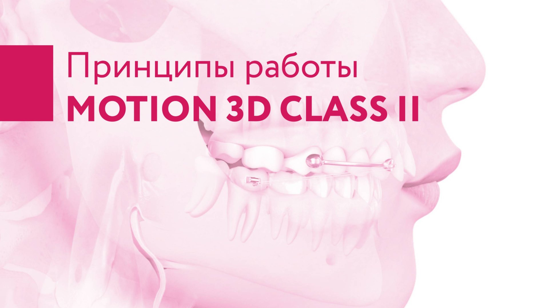 Принцип работы аппарата Carriere Motion 3D Class II