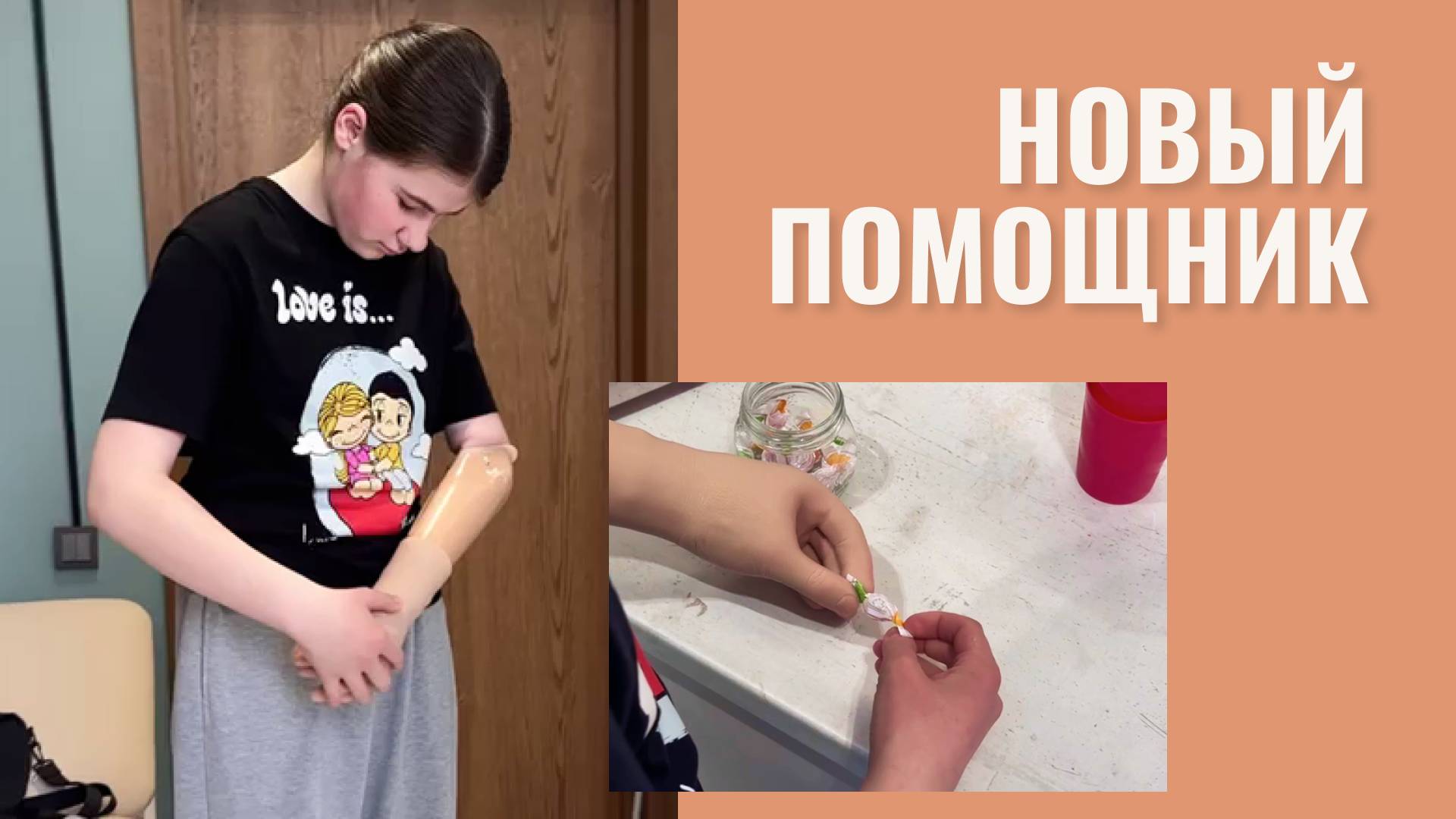 Новый протез руки для девочки