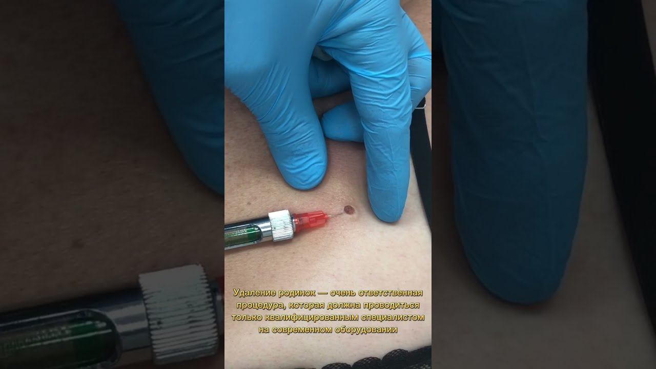 Удаление родинки на аппарате Сургитрон