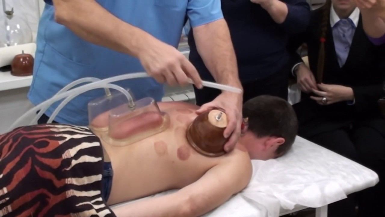 Аппаратный вакуумный массаж спины. Аппарат Смирнова.