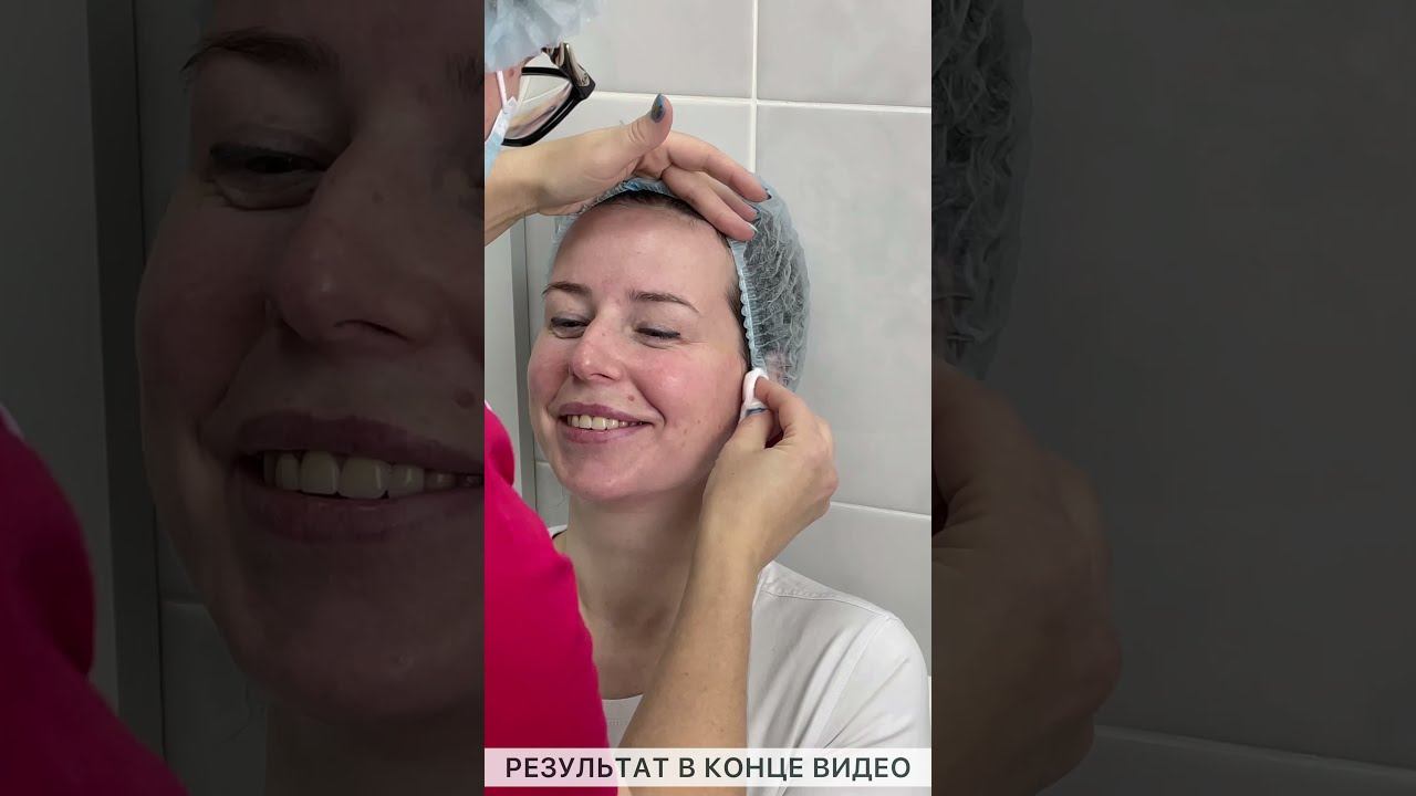 Подтяжка нитями Aptos