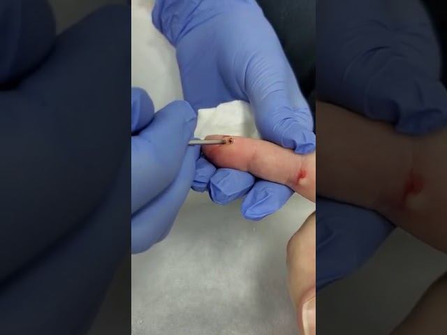 Удаление бородавок лазером