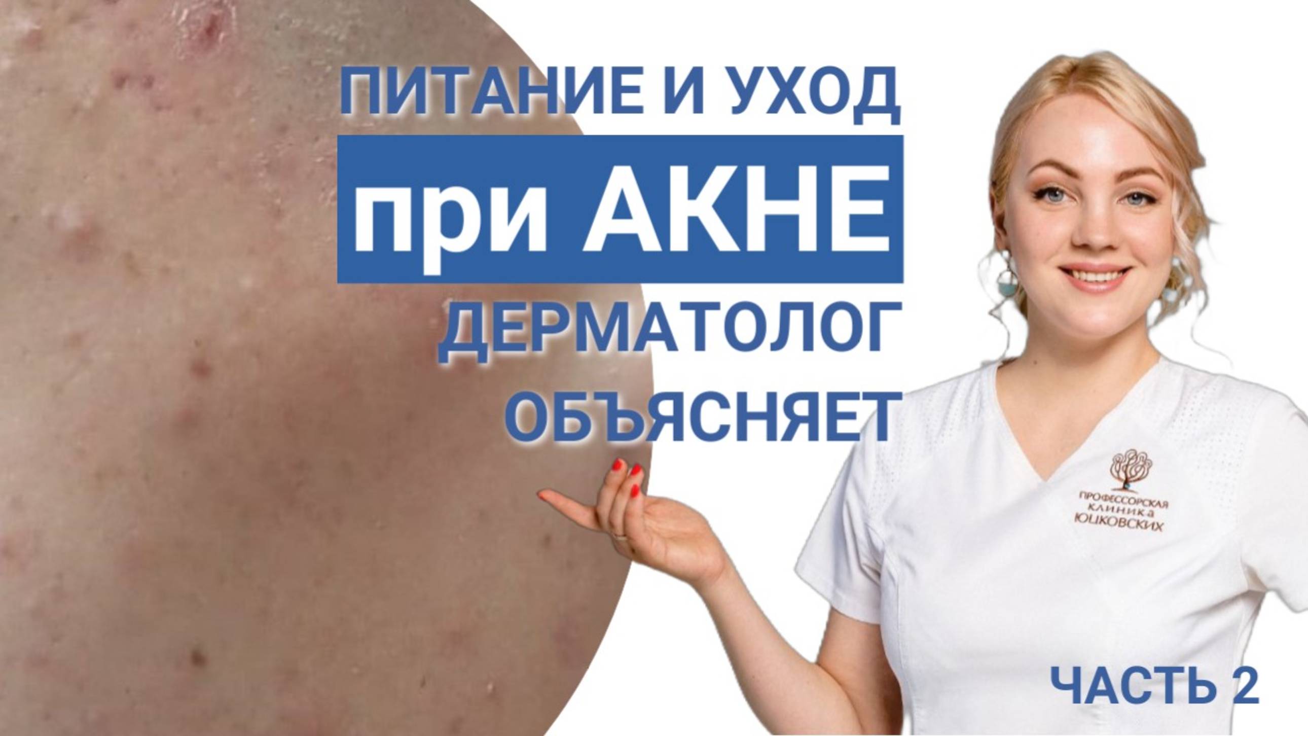 Питание и уход при акне: мнение врача-косметолога профессорской клиники Юцковских.